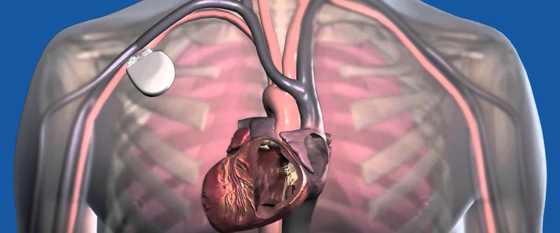 What is aa and how does it work?